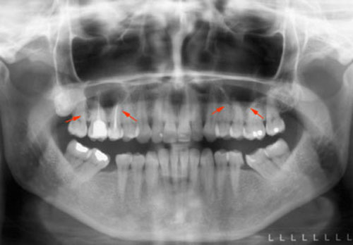 Elevación del seno maxilar - Blog Dentisalut