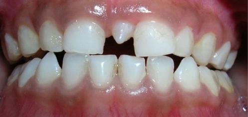 ¿Tienes un diente extra? - Dentisalut